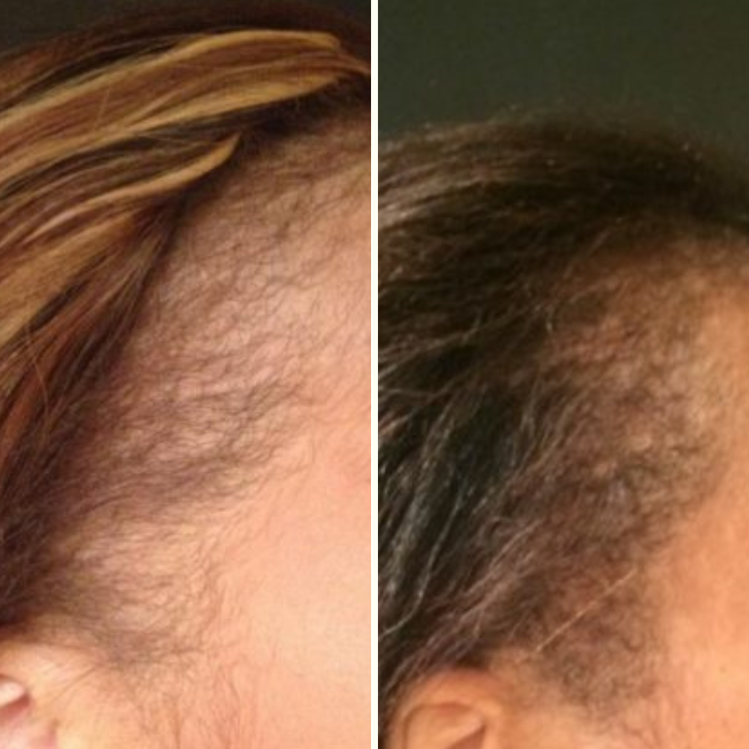 Endoten Control Serum- 90 Days Treatment Challenge