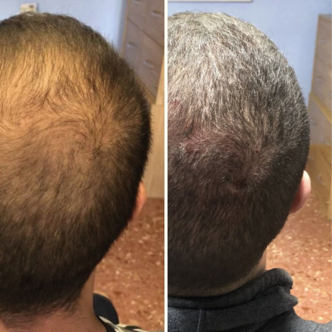 Endoten Hair / Regenerate your scalp's health